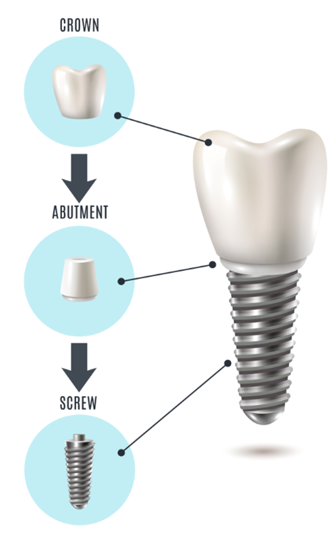 Dental Implants: The Future of Tooth Restoration | Smile Country Dental